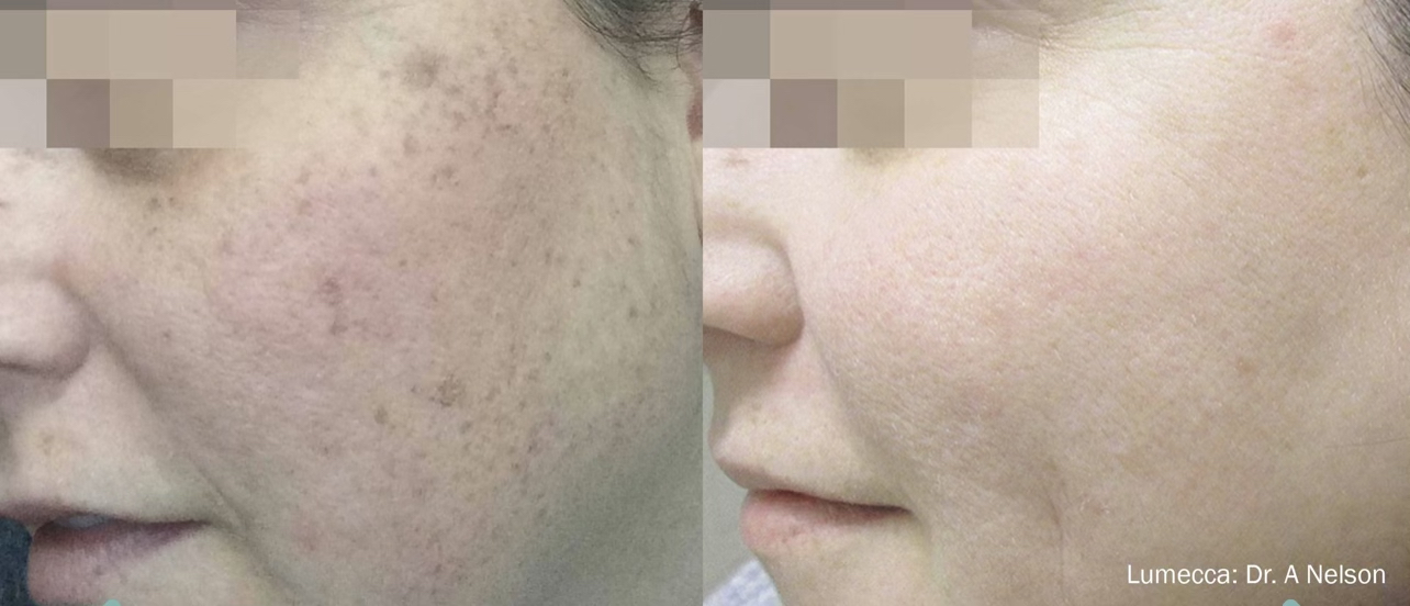 IPL Laser Treatments in Columbus Ohio | Reverse Aesthetics